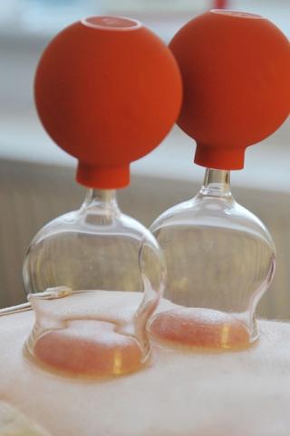 Cupping Techniques | Real Time Pain Relief